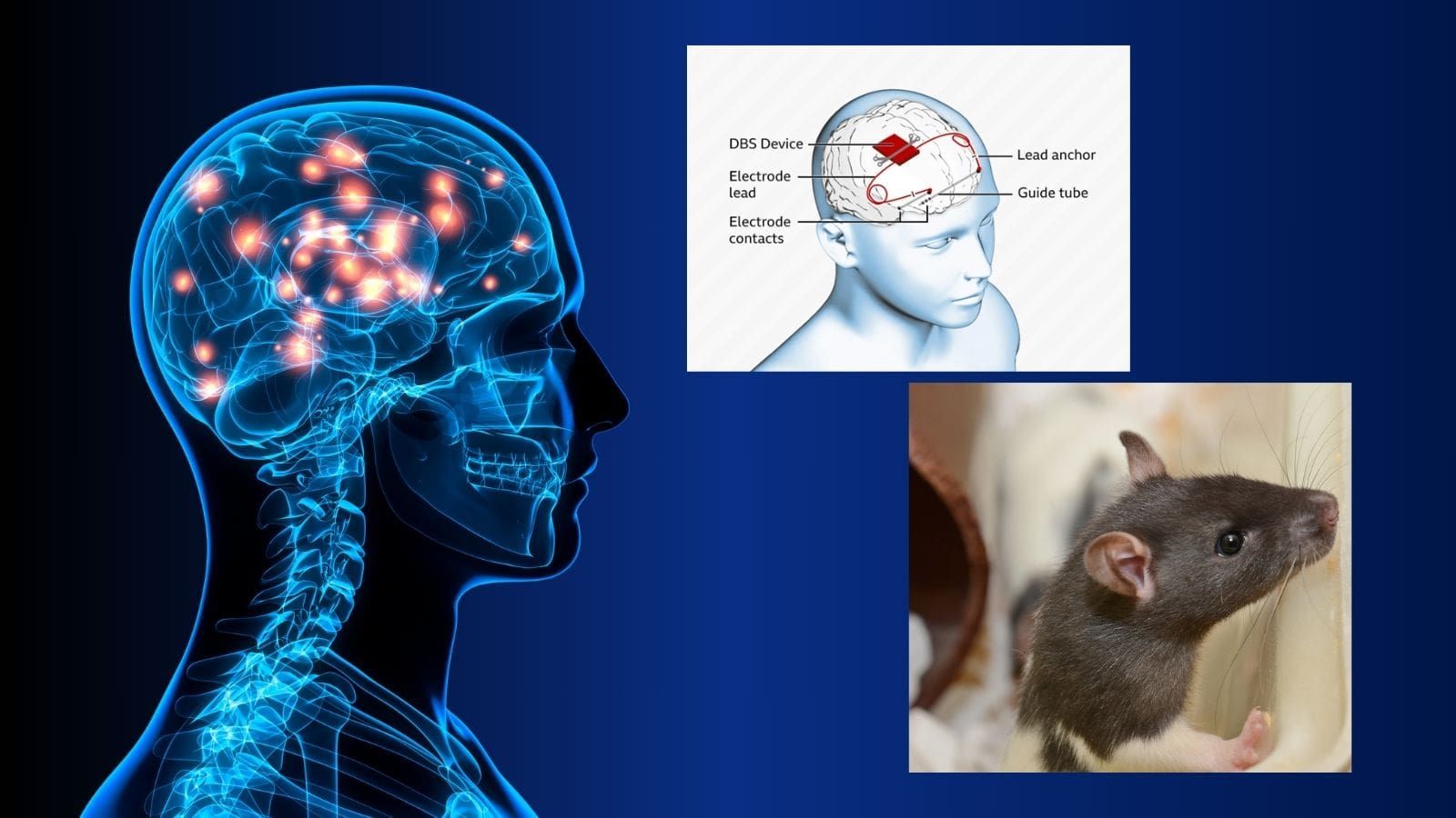 The animal research behind a new device to treat epilepsy – Epilepsy ...